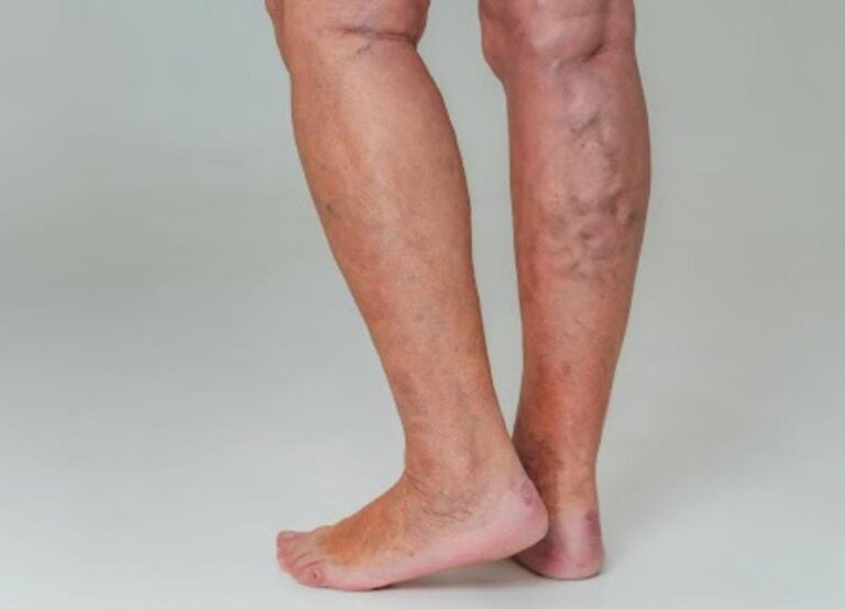 Spider Varicose Veins Causes, Symptoms and Treatment Center NYC